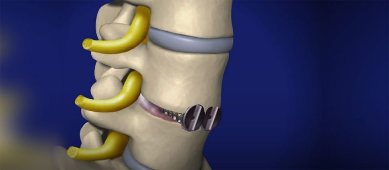 Lumbar Inter-Body Fusion (IBF) | Haider Spine Center